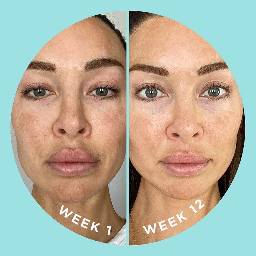 ZitSticka Blur Potion: Vitamin Supplement for Hyperpigmentation ...