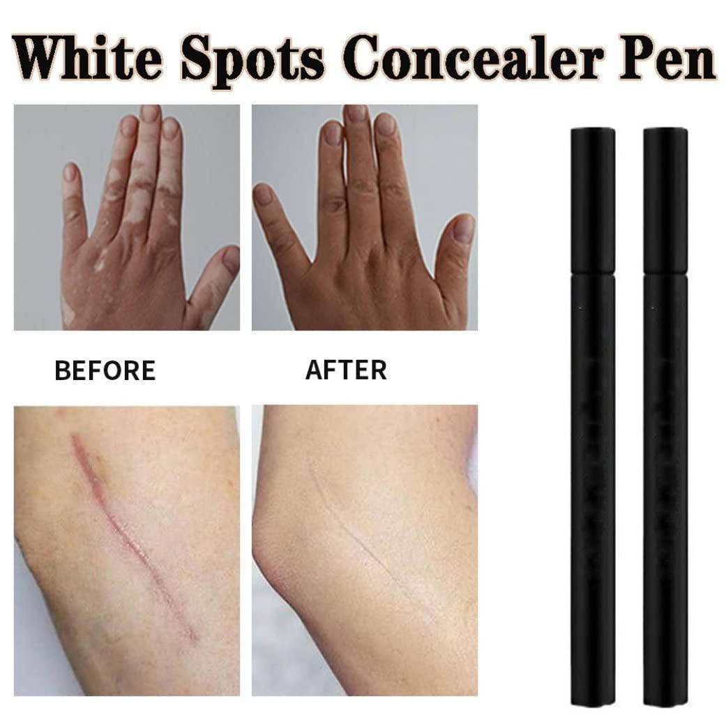 White Spots Concealer Pen - Waterproof & Long Lasting | Vitiligo, Scars ...