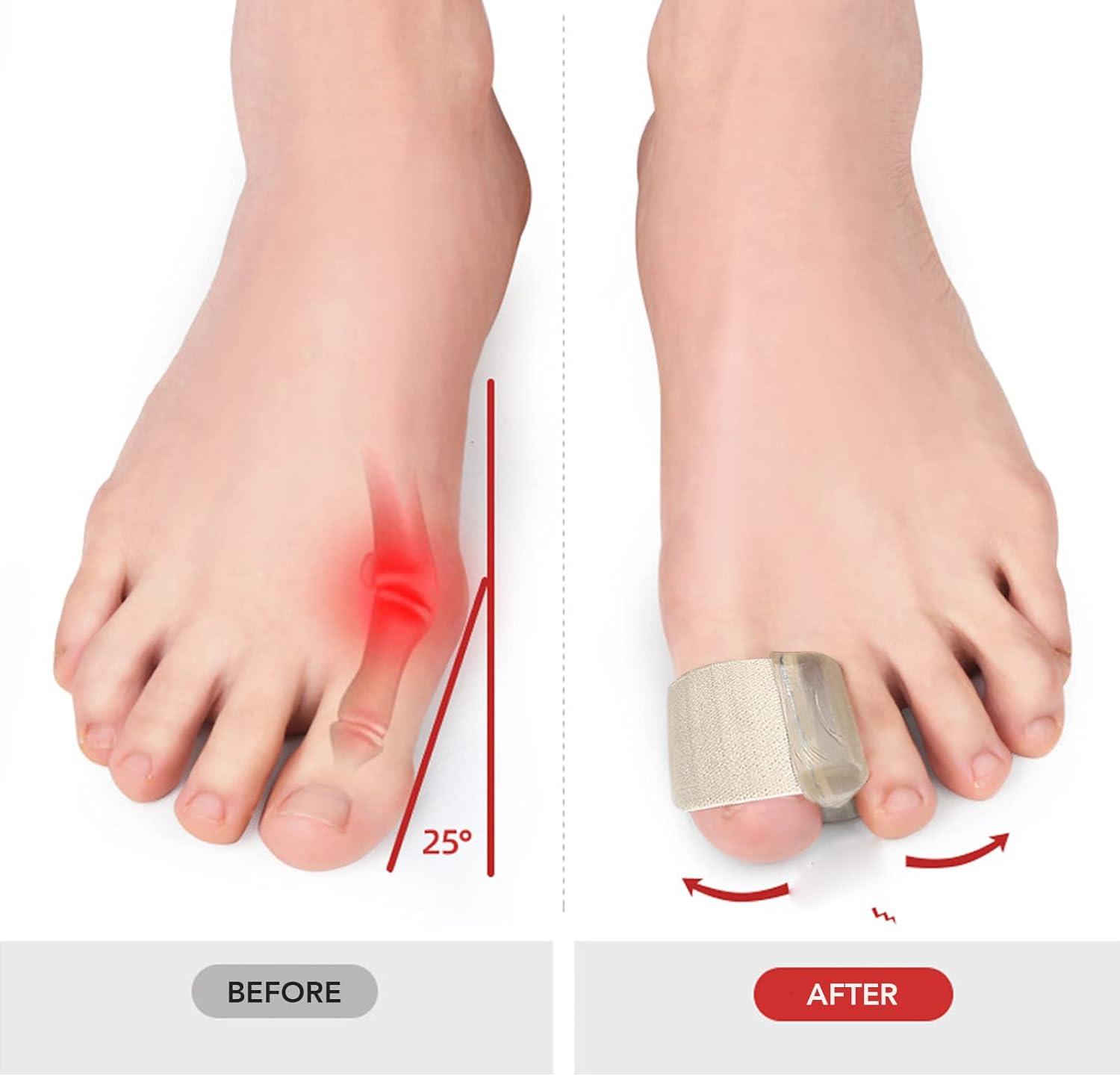 Professional Toe Corrector: Toe Splitter Prevents Friction, Comfortable ...