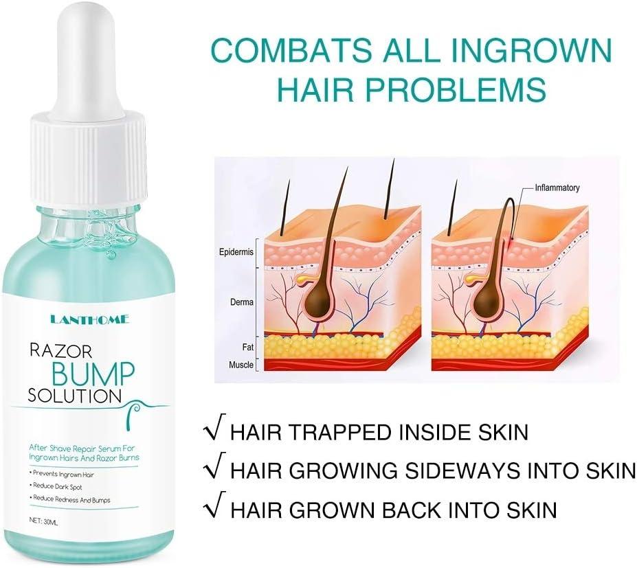 Razor Bumps Solution Skin Ingrown Hair Solution Bumps Reduce Redness ...