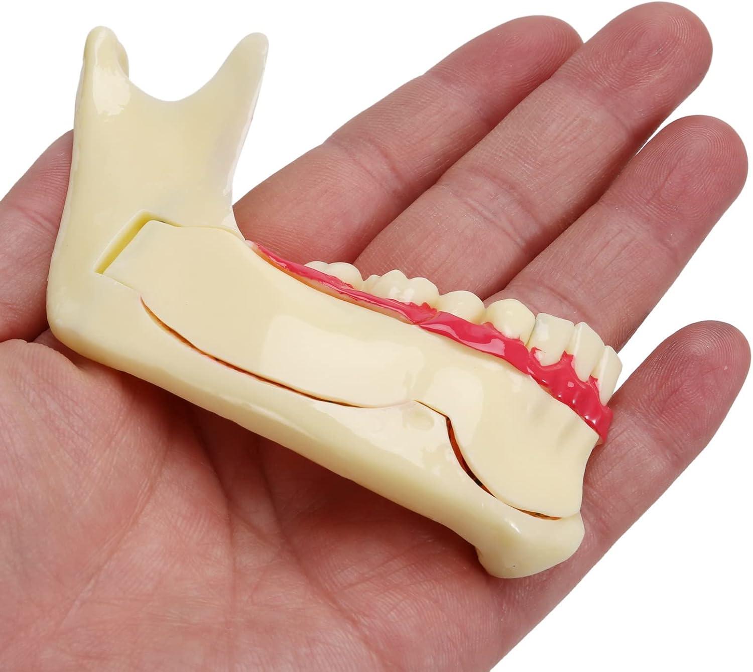 Acfthepiey Dental Treatment Model - Anatomy of Gums & Teeth Study Tool ...