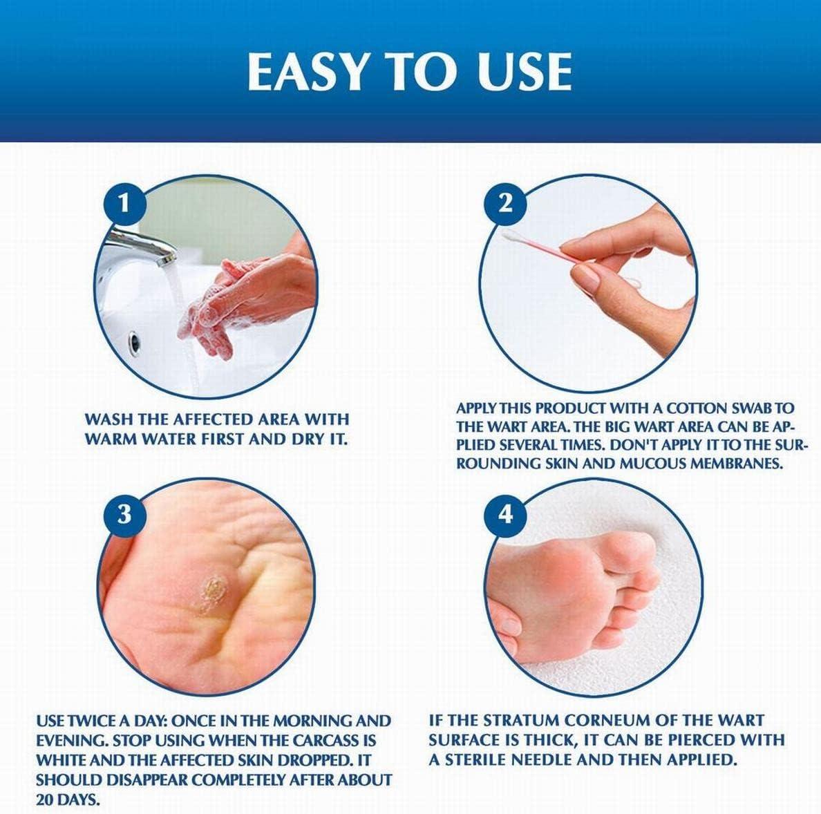 Gafig Wart Remover - Painlessly Removes Common Hand and Plantar Warts ...