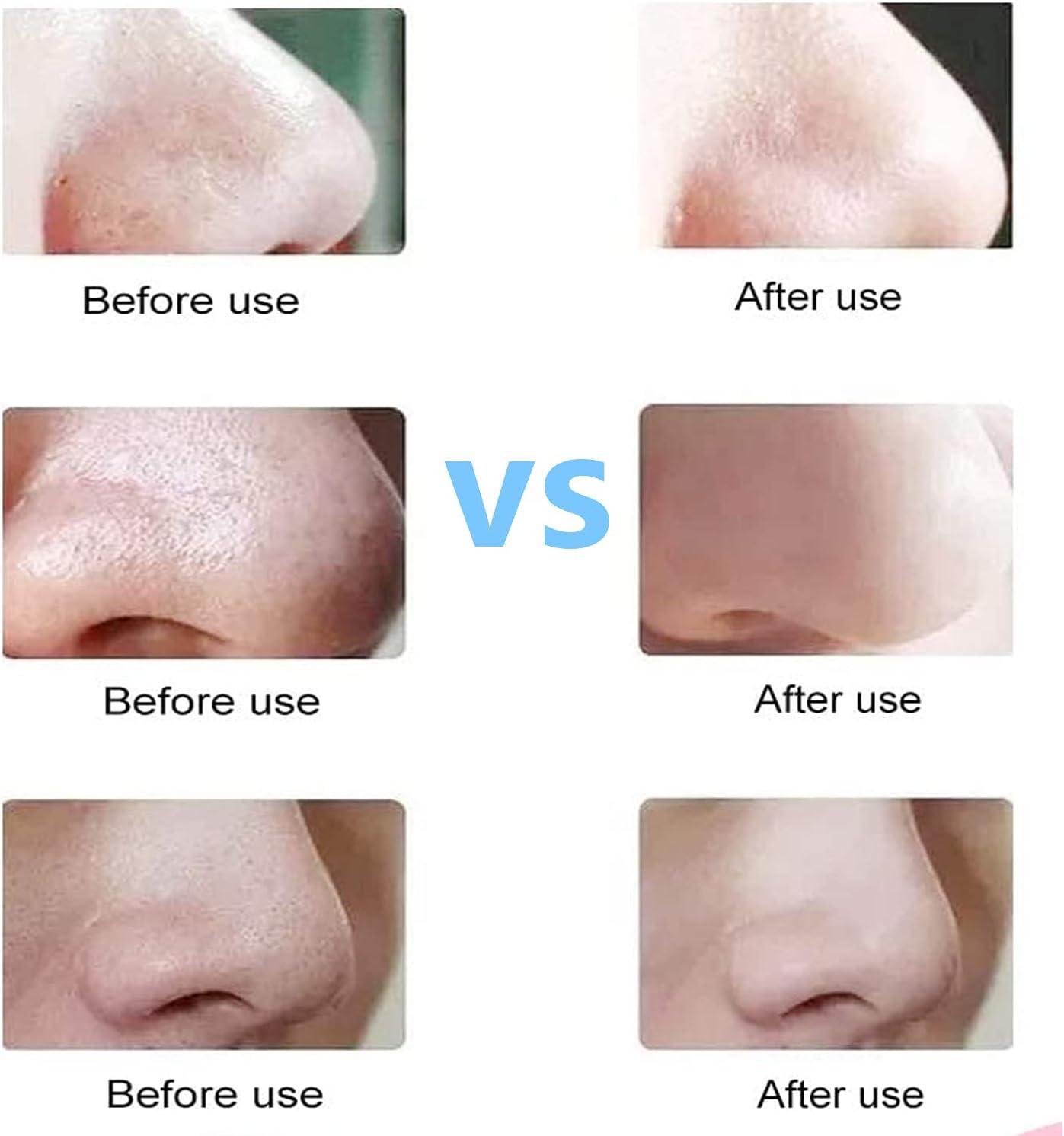 Blackhead Extractor Before And After
