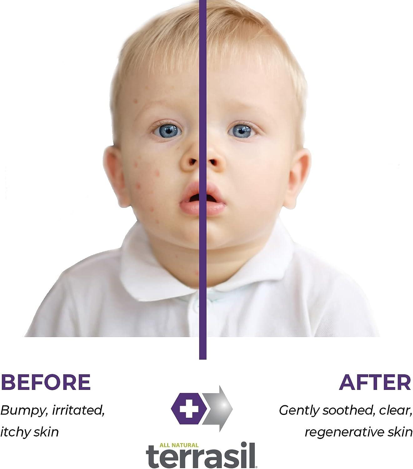 Terrasil Molluscum Contagiosum Ointment for Symptom Relief - All ...