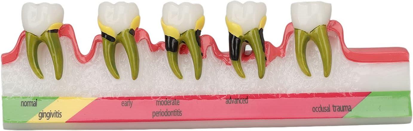 Dental Model for Periodontitis - Realistic Teaching Aid Resin Model for ...