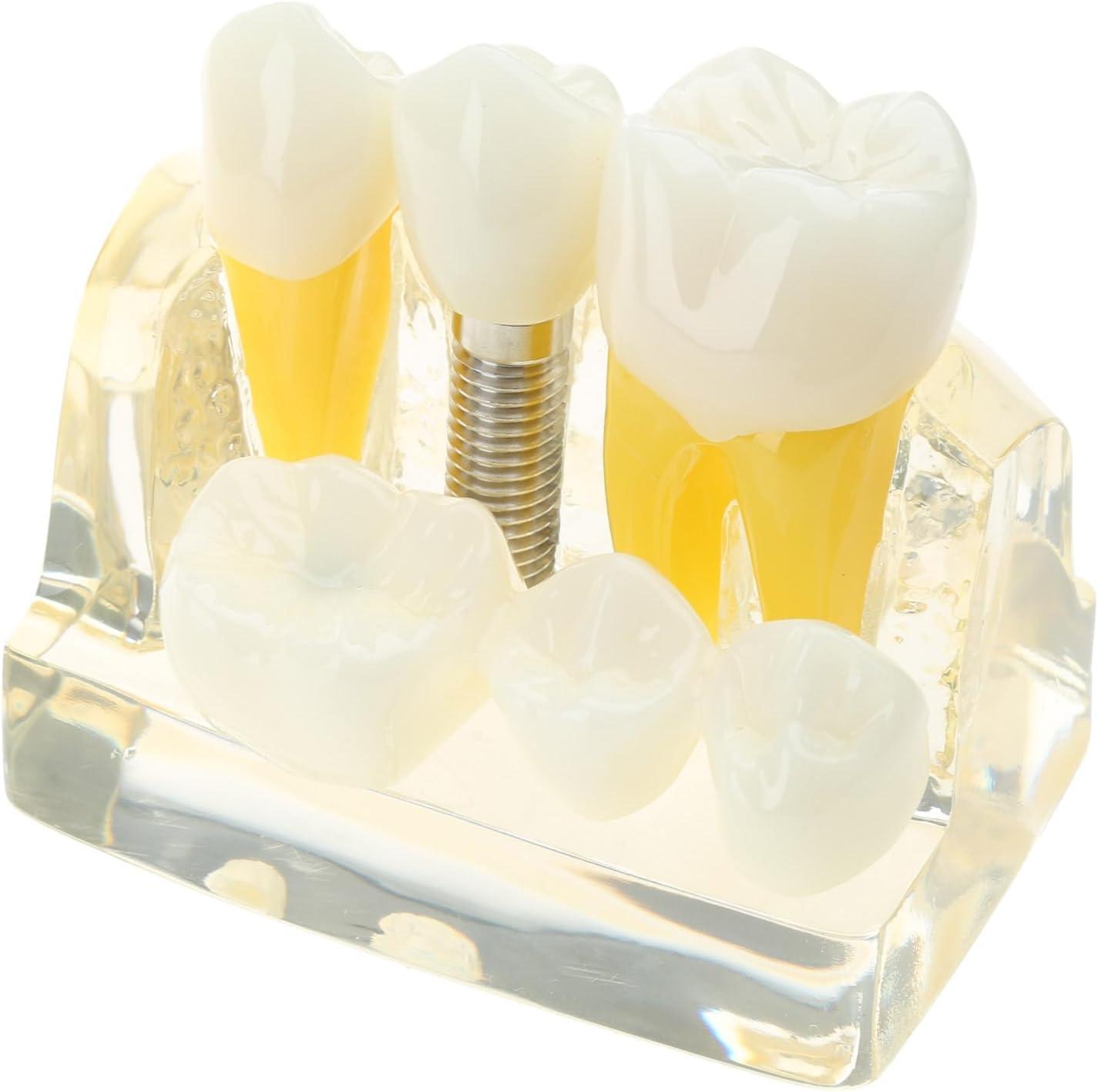 Implant Model Removable Bridge - Educational Teeth Model for Dental ...