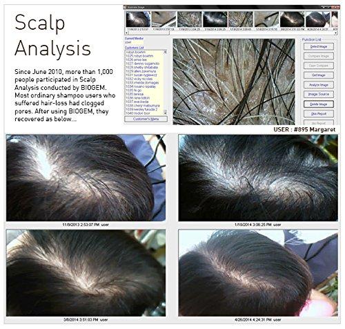 Dr Ross' BIOGEM Hair Loss Care Set - Shampoo & Conditioner 10oz ...