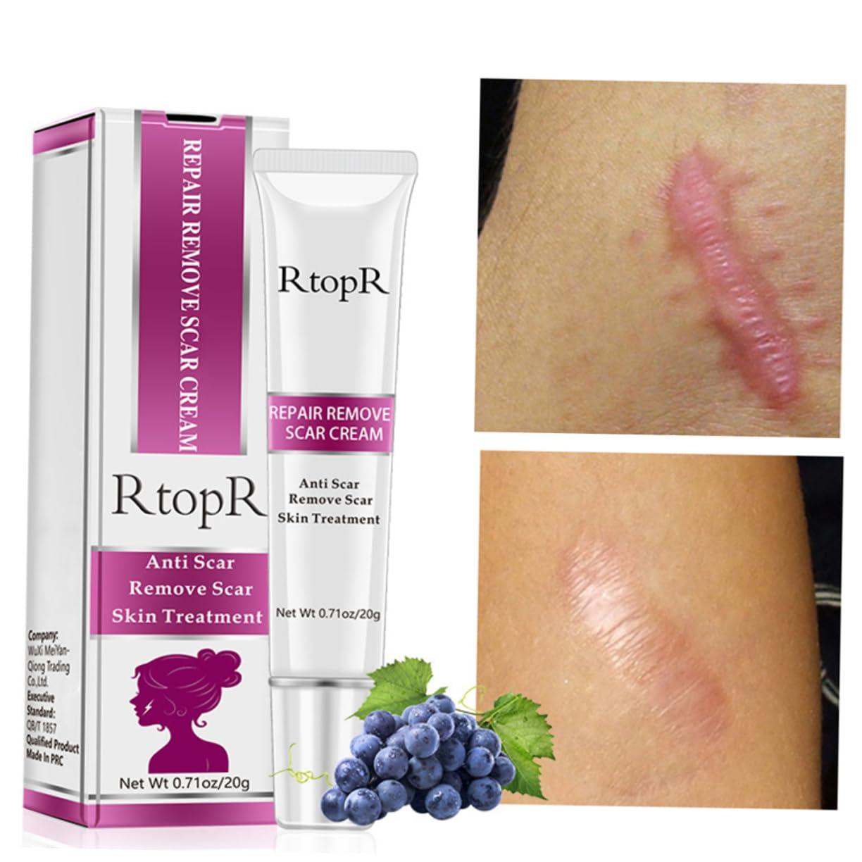 Healifty Scar Cream Gel for Face & Body - Stretch Mark & Scar Remover ...