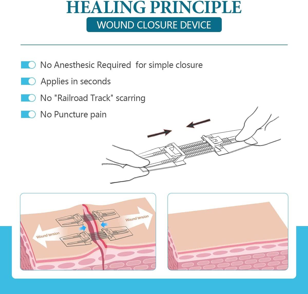 Zip Stitch Wound Closure Kit 4 Pcs | Quick Clot for Outdoor Activities ...