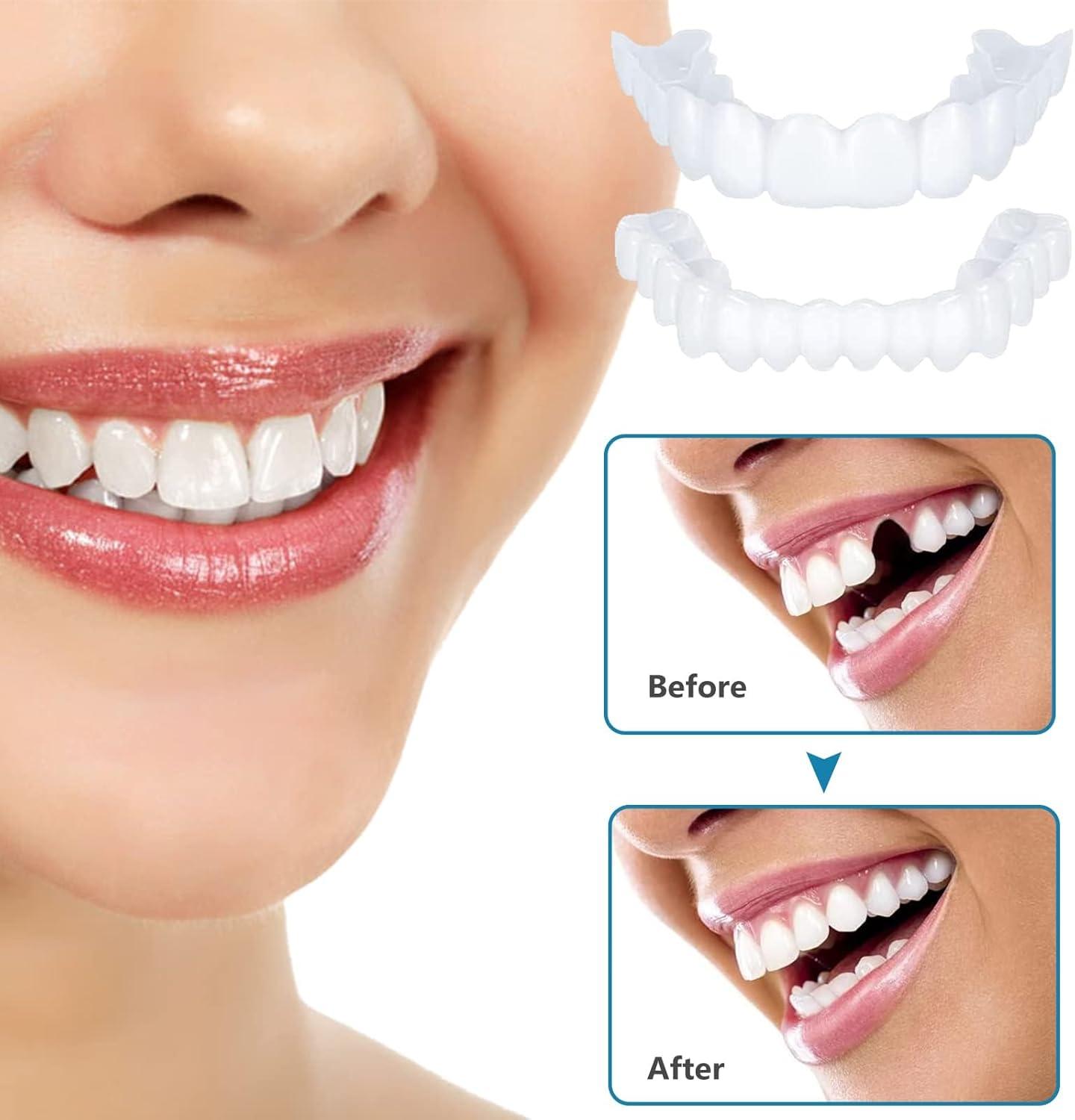 Perfect Smile Snap-On Teeth - 2 Pairs of Veneers for Men & Women ...