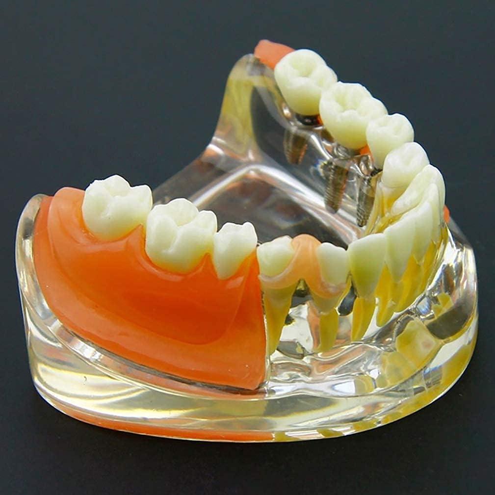 Dental Implant Restoration Model | Removable Bridge & Denture Demo for ...