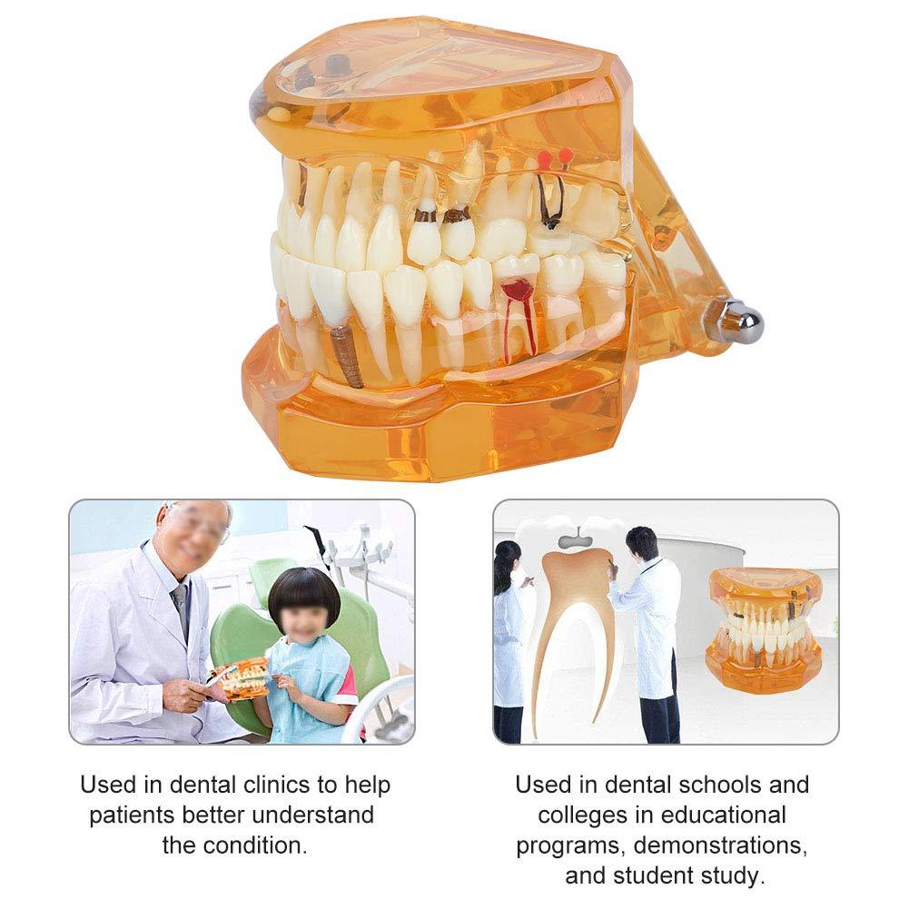 1-Piece Orange Tooth Model for Dental Education | Removable Denture ...