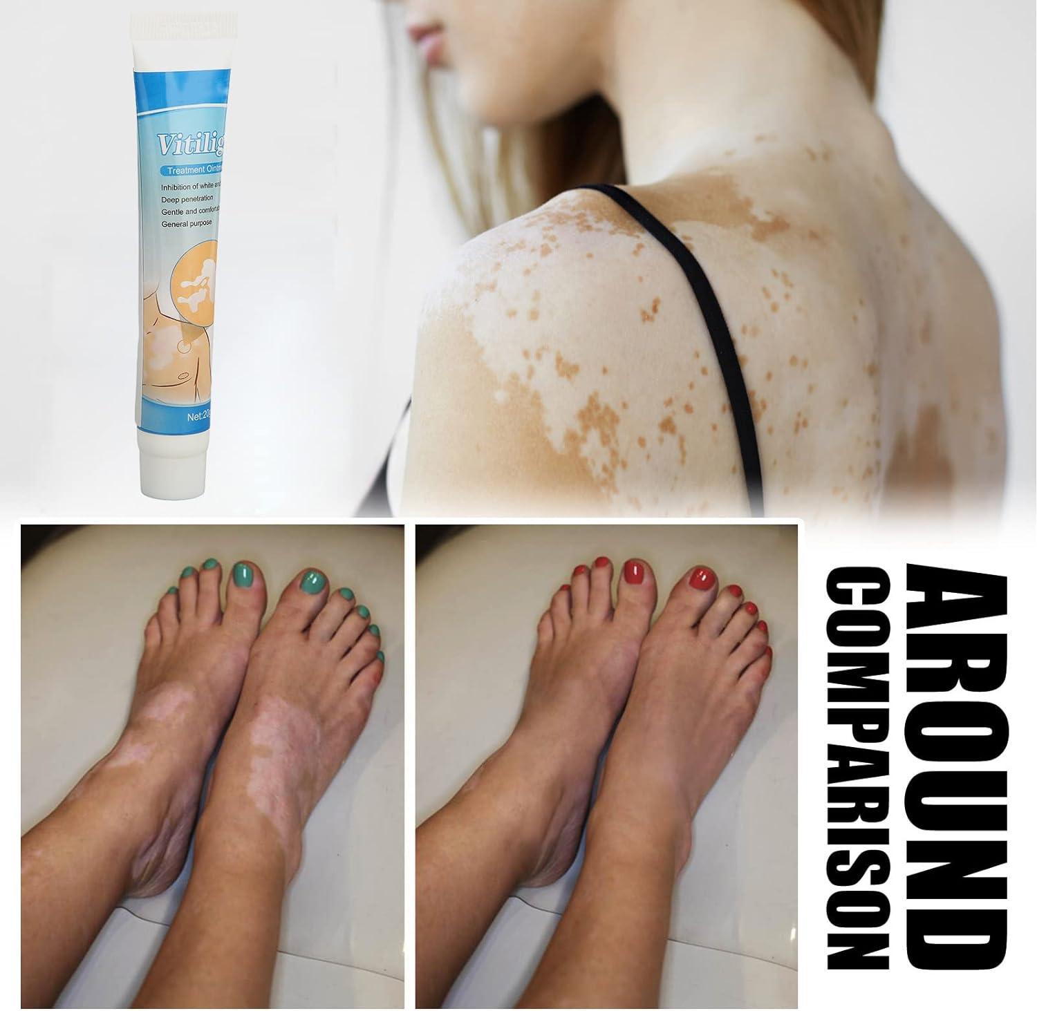 Vitiligo Treatment Cream 20g - Herbal Extract for White Spots & Skin ...