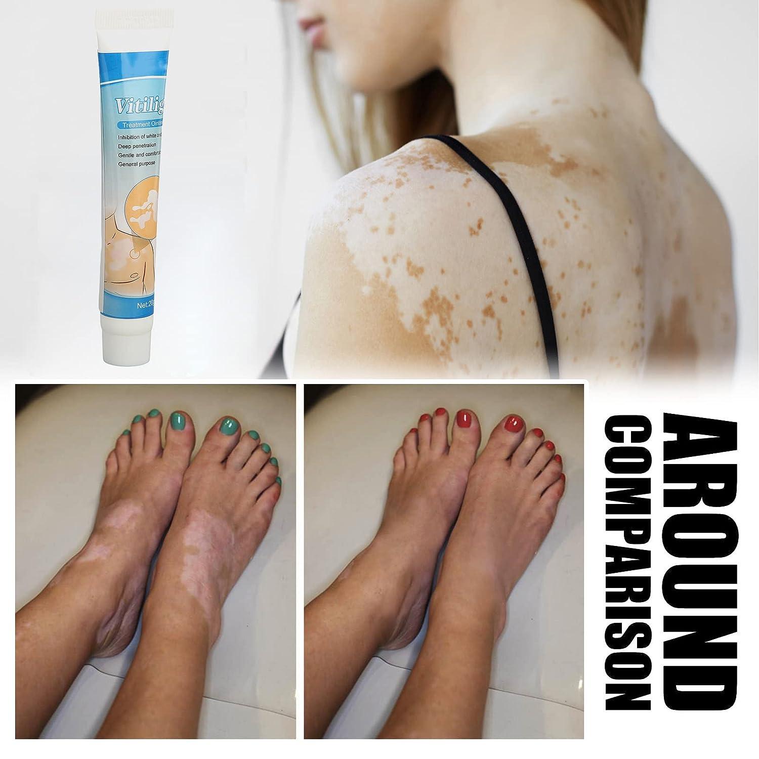 Vitiligo Care Cream for Skin - Reduces White Spots, Improves ...