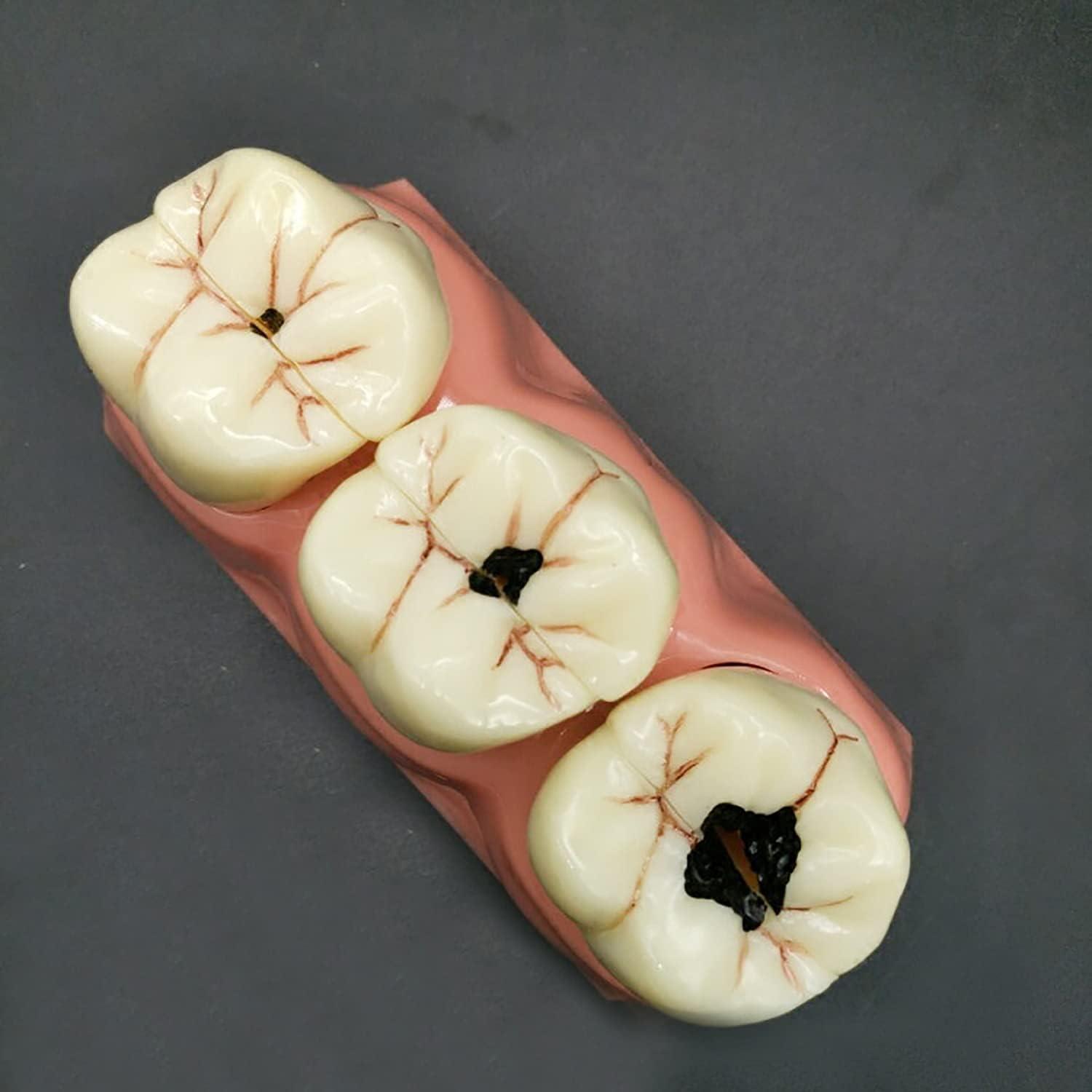 Buy Samnuerly 4-Fold Dental Teeth Caries Model - Removable Tooth ...