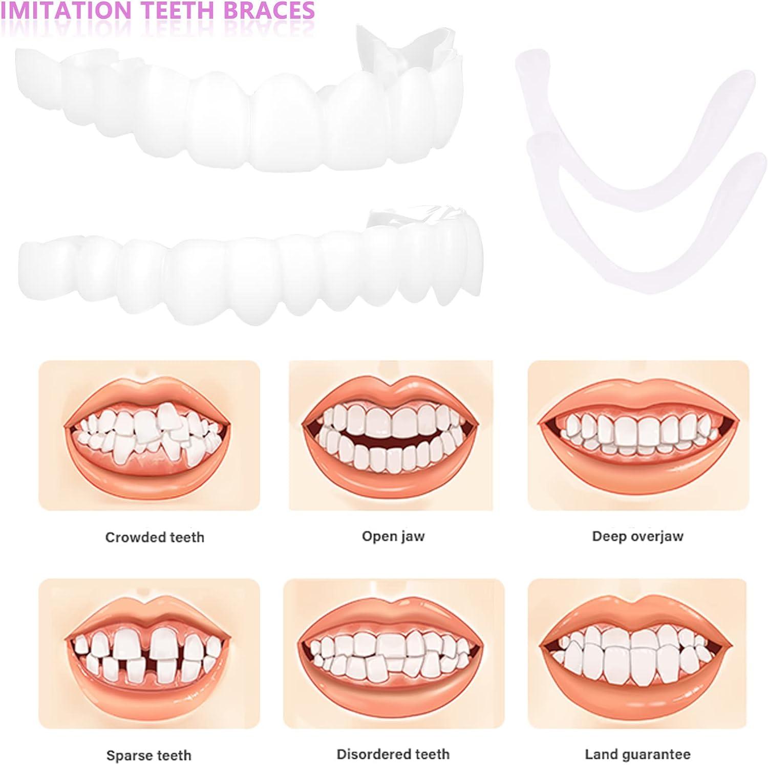 Snap-On Smile Instant Veneers - Top & Bottom Fake Teeth Dentures | Buy ...