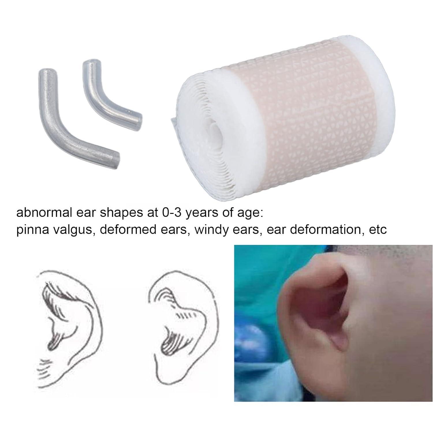 Silicone Auricle Valgus Correction Patch for Protruding Ears ...