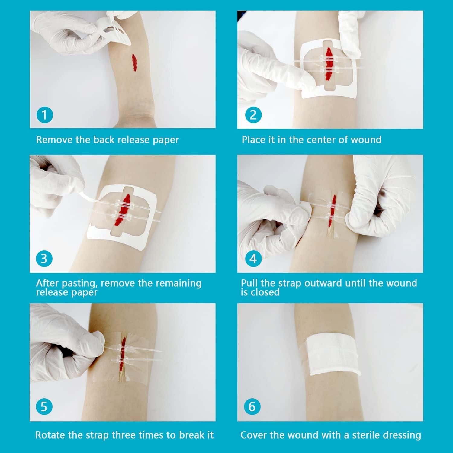 Greetmed Zip Stitch Sutures Butterfly Bandaids - 4 Pcs Laceration ...