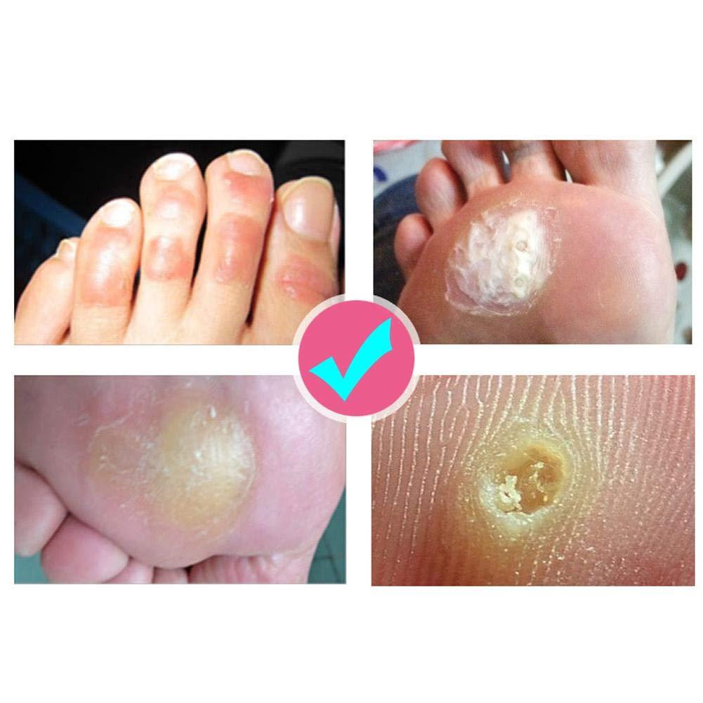 Corn Removal Plaster for Foot Corns, Calluses, Brittle Nails, and ...