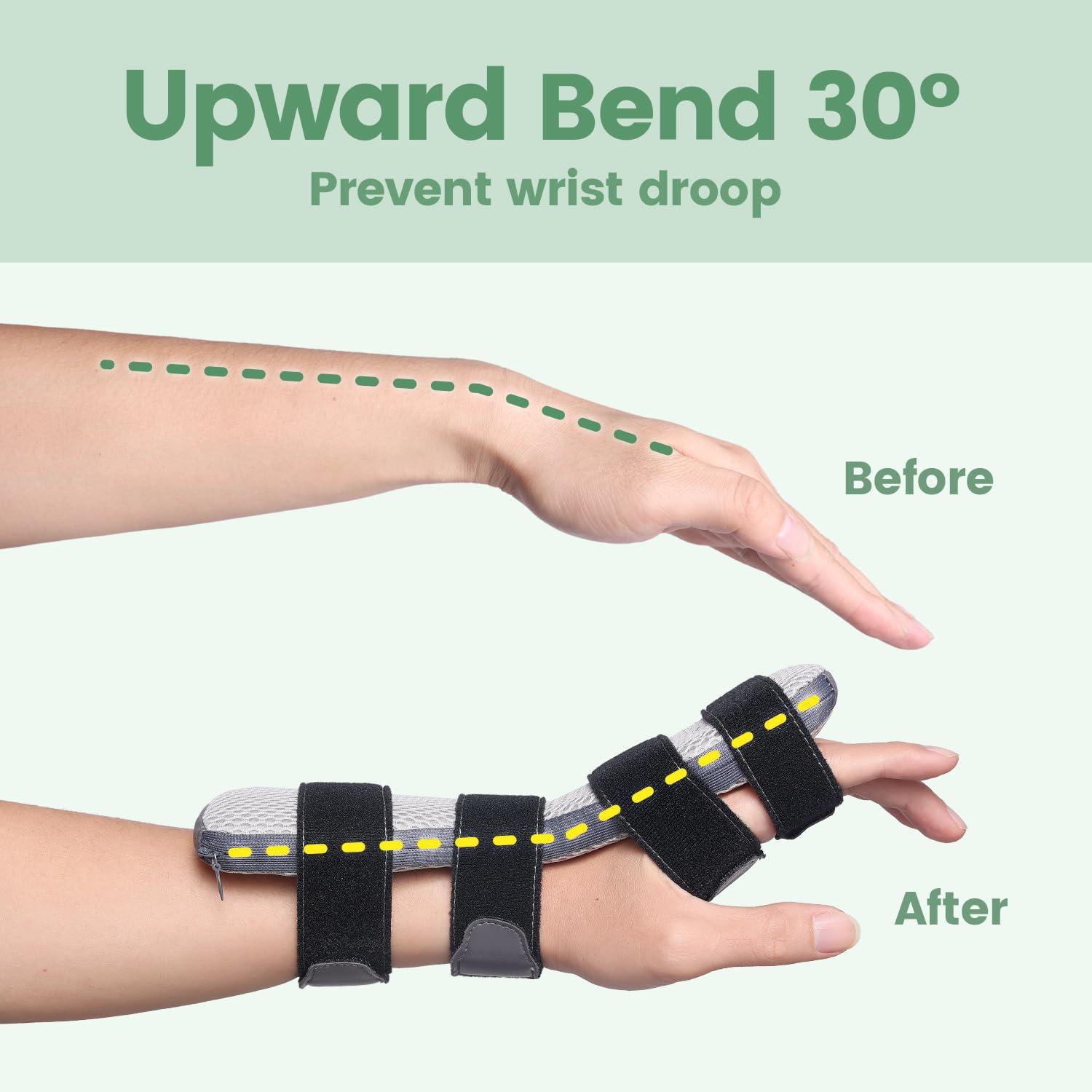 Radial Nerve Palsy Splint - Adjustable Wrist Drop Brace for Stroke ...