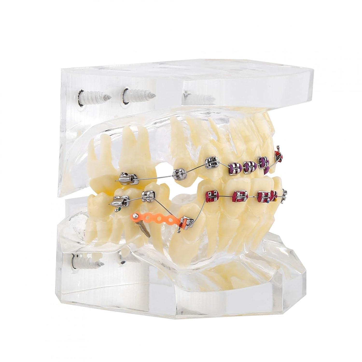 Dental Teeth Model with Metal Brackets - Orthodontic PVC Resin for ...