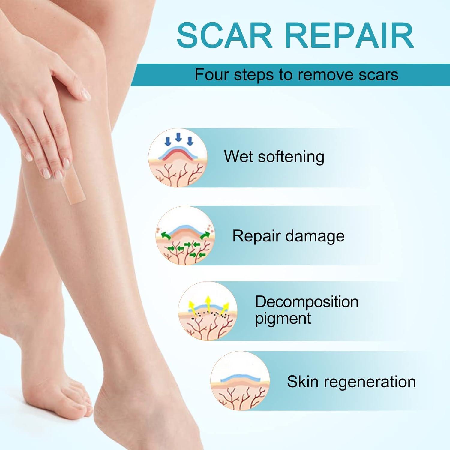 Medical Grade Silicone Scar Sheets - 5 Reusable Professional Gel ...