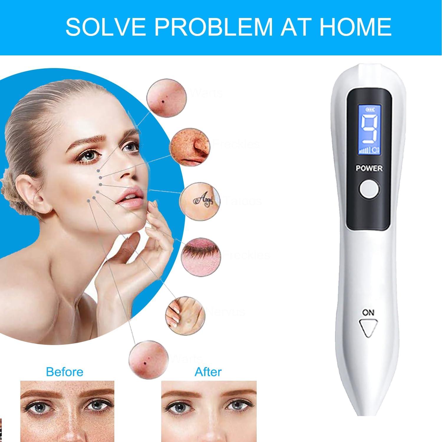 WART & Skin Tag Removal Kit for Women - Model 40226 | Buy Now with ...