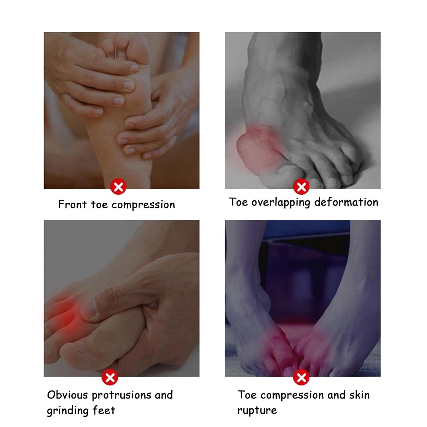 Toe Separator - 2 Silicone Gel Pads for Big Toes | Orthopedic Solution for Overlapping Toes ...