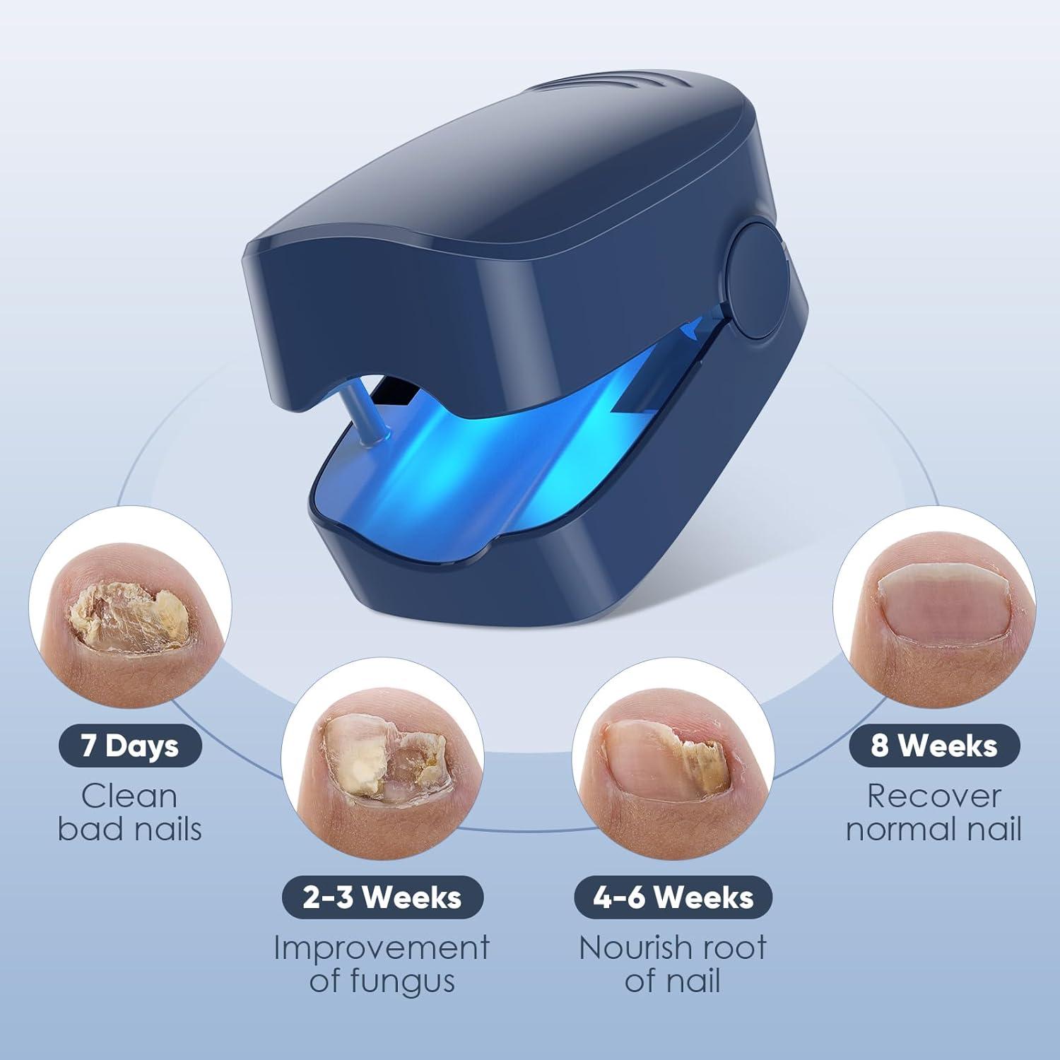 URMIIM Nail Fungus Light Device - Effective Home Nail Cleaning for ...