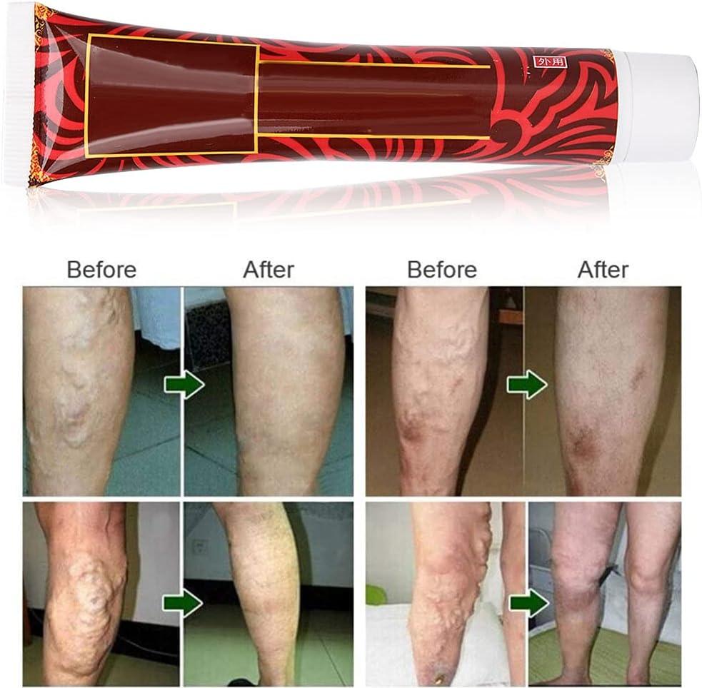 Varicose Vein Treatment Cream for Phlebitis & Angiitis | Blood Vessel ...