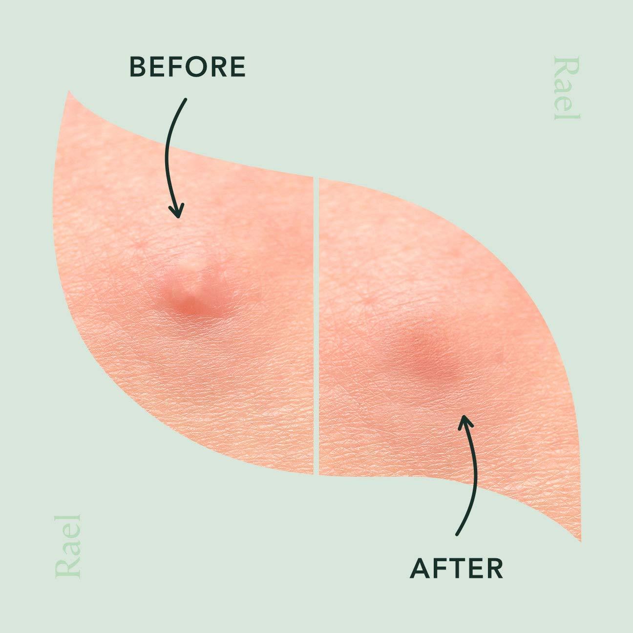 Rael Miracle Microcrystal Spot Cover - Hydrocolloid Acne Pimple Patch ...