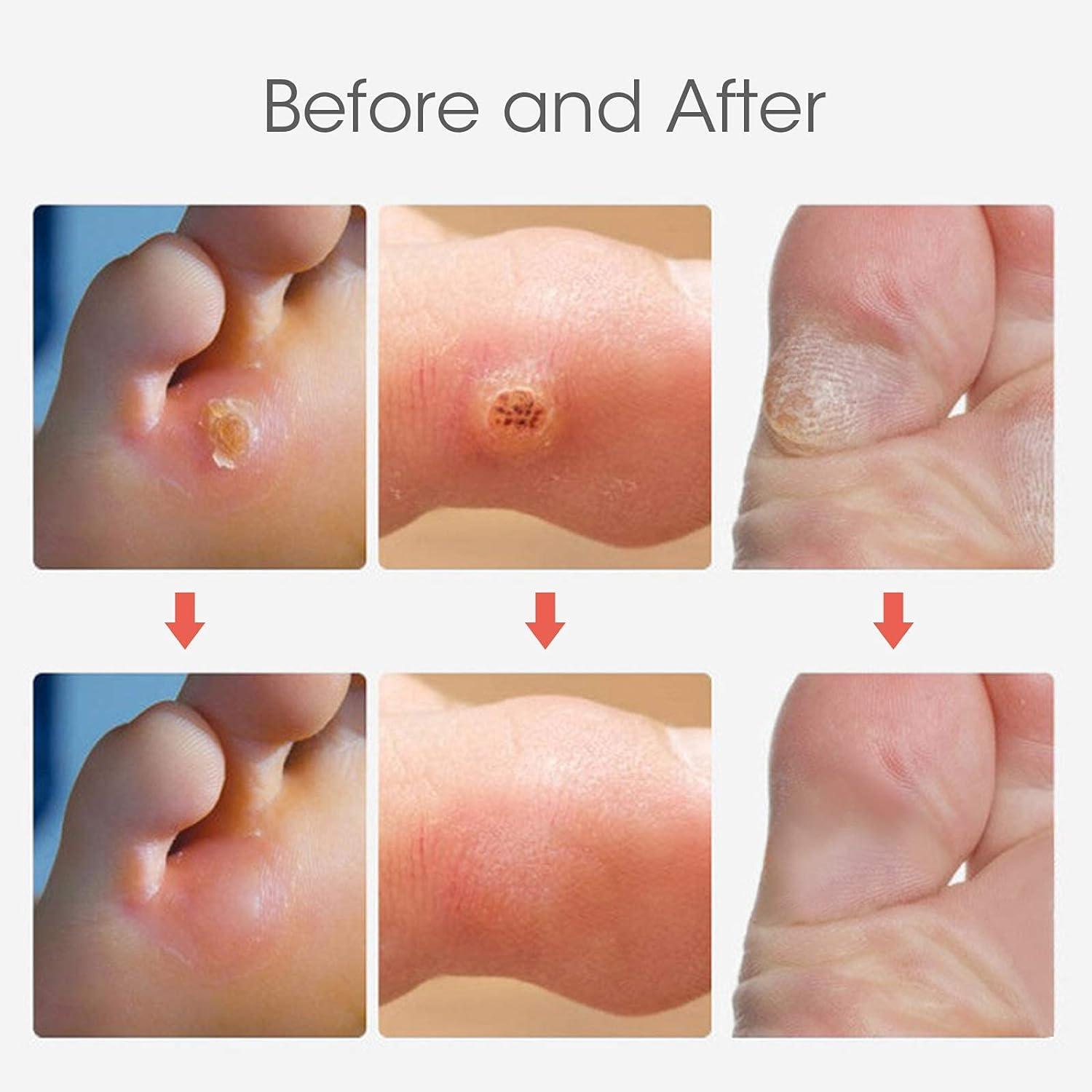 Corn Remover Pads - 24 Pcs Wart & Corn Removal Patches for Feet & Hands ...