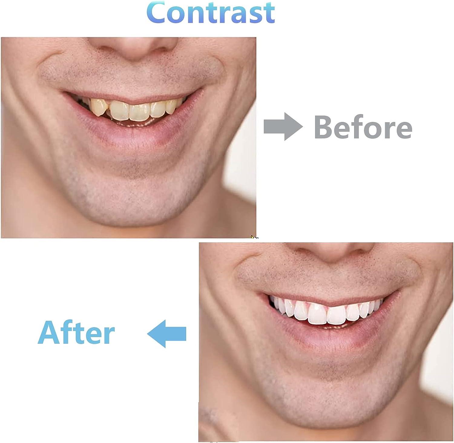Temporary Tooth Repair Kit - 6PCS Fake Teeth Filling for Fixing Missing ...
