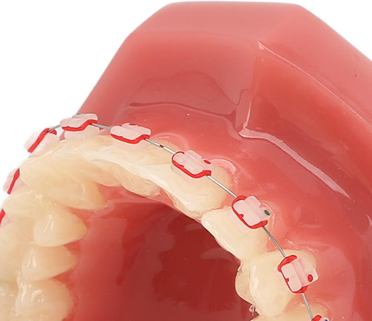 Orthodontic Bracket Model - Educational Demonstration with Metal Wires ...