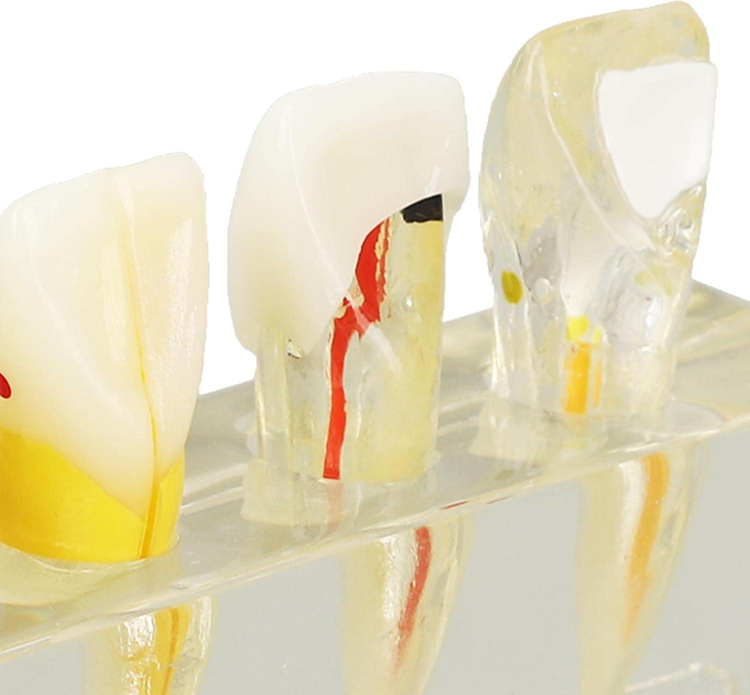 Endodontic Model - Stable Portable Dental Pulp Model for Practice ...