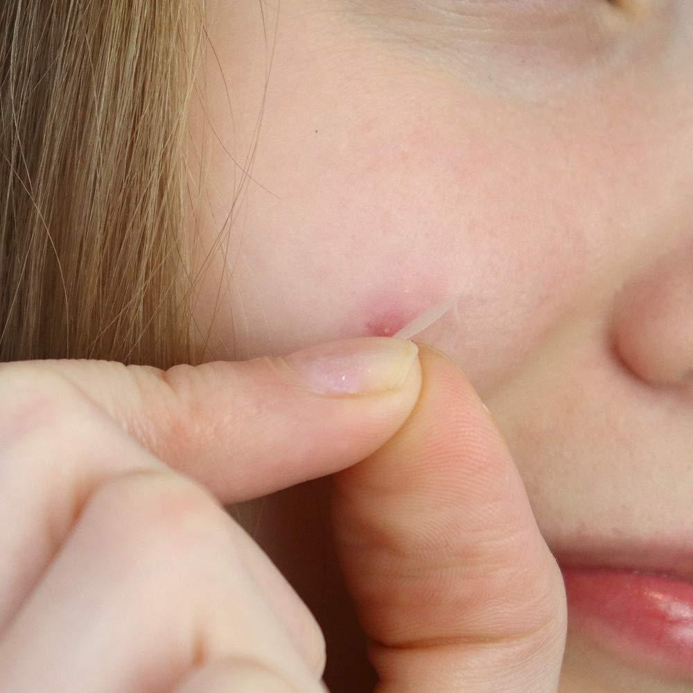 DERMAKR Discreet Acne Pimple Patch - Treatment Solution for Cystic Acne ...