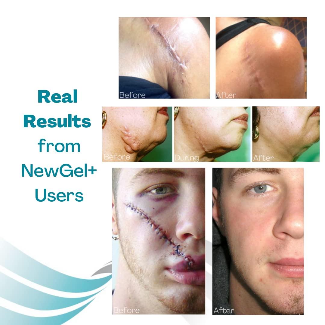 NewGel+ Advanced Silicone Scar Treatment Strip 1mm Thick - 3 Count ...