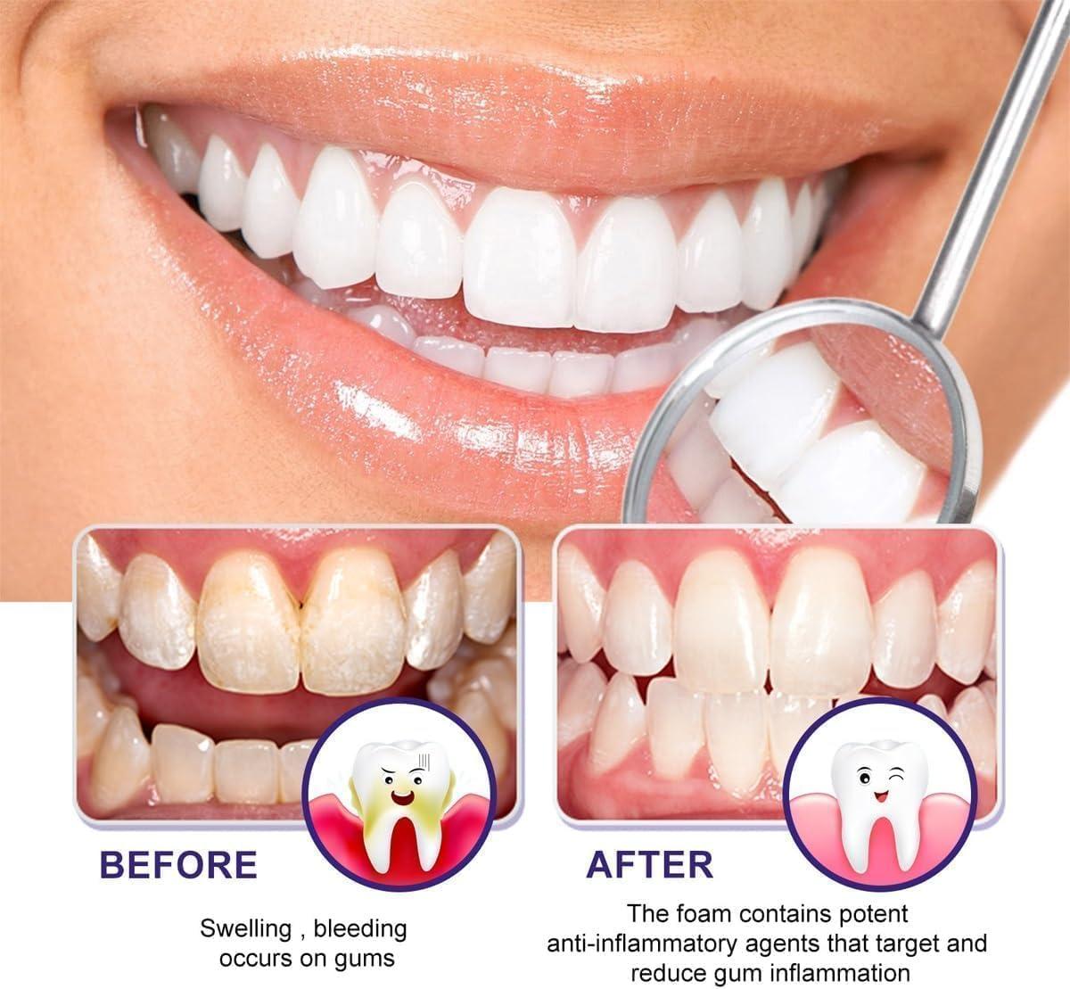 EXQST Gum Treatment Foam Gum Tissue Regeneration and Repair Deep Stain ...