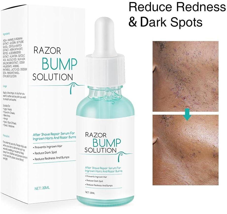 CeFoney Skin Dent Ingrown Hair Prevention Serum - Razor Bump & After ...