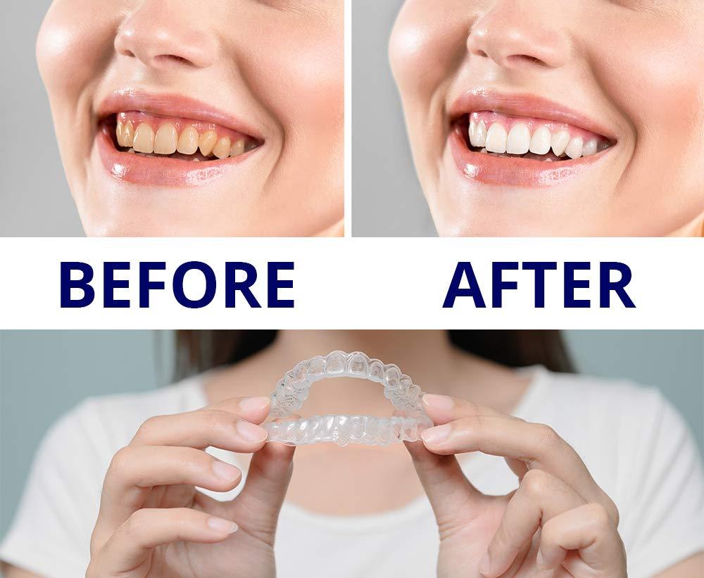 Custom Teeth Whitening Trays + 2 Syringes of Premium Gel | Dentist ...