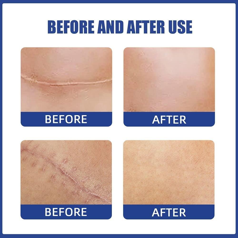 Andy's Orchids Silicone Scar Sheets - Medical Grade Reusable Silicone ...