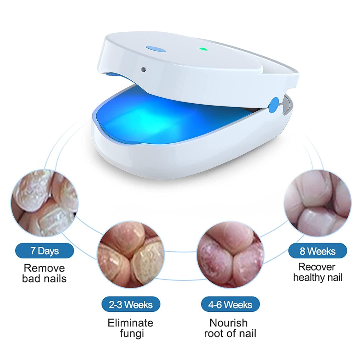 iKeener Nail Fungus Cleaning Device - Improve Nail Health in 7 Minutes ...