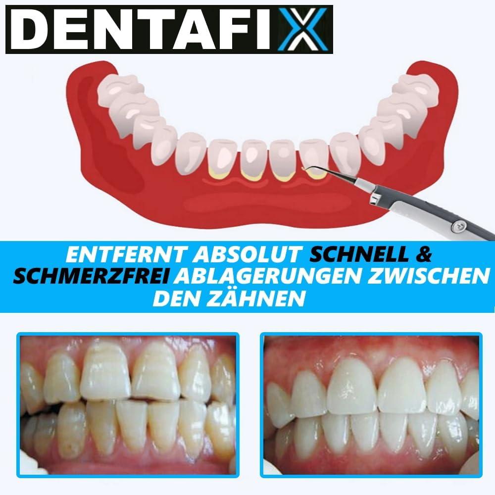 Dentafix Electric Tartar Remover - Ultra Sonic Tooth Cleaner & Plaque ...