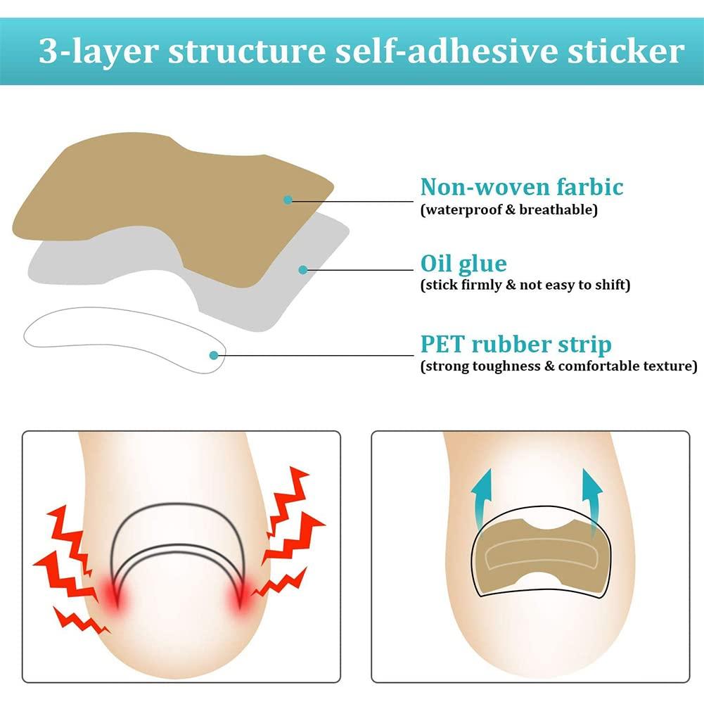 Ingrown Toenail Correction Stickers - Professional Elastic Patch for ...