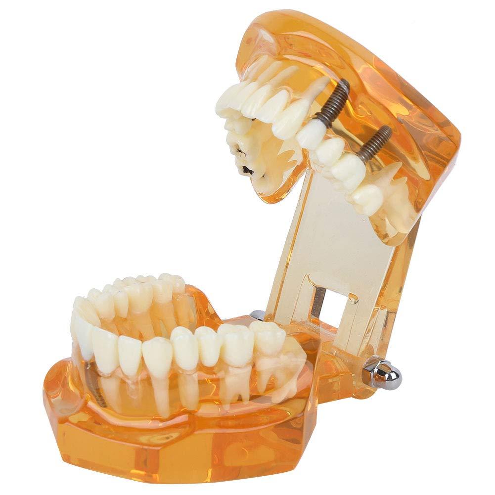 High-Quality Disease Dental Teeth Model - Removable Tooth Implant ...