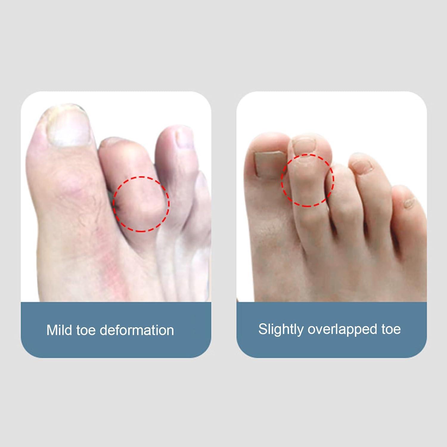 Toe Straightener Splint for Plantar Fasciitis Relief - Sponge Composite ...