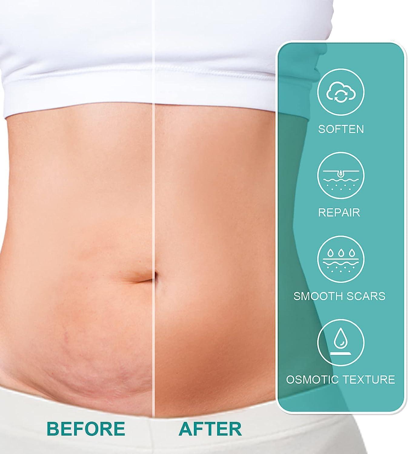 Southmoon Medical Grade Scar Removal Spray - Advanced Formula for ...