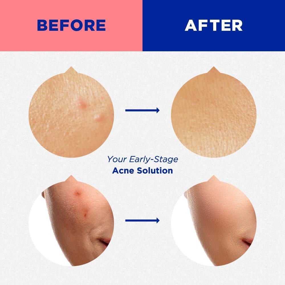 FANOFI Micro-Needle Acne Soothing Patch - Fast-Acting Treatment for ...