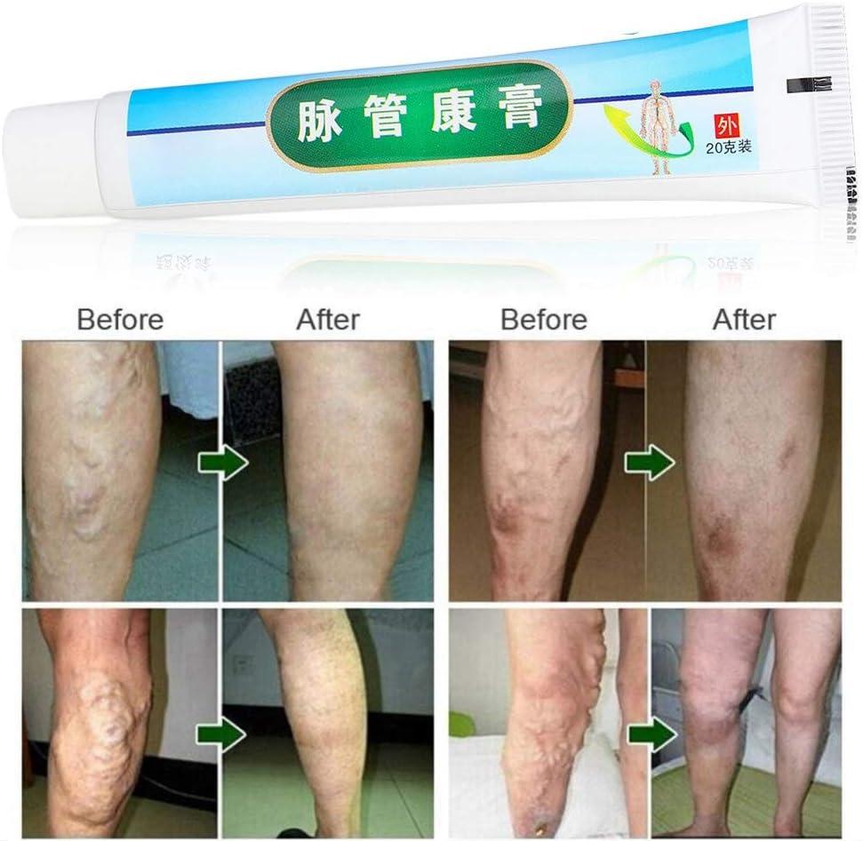 Varicose Veins Cream & Ointment for Relief | Phlebitis Angiitis ...
