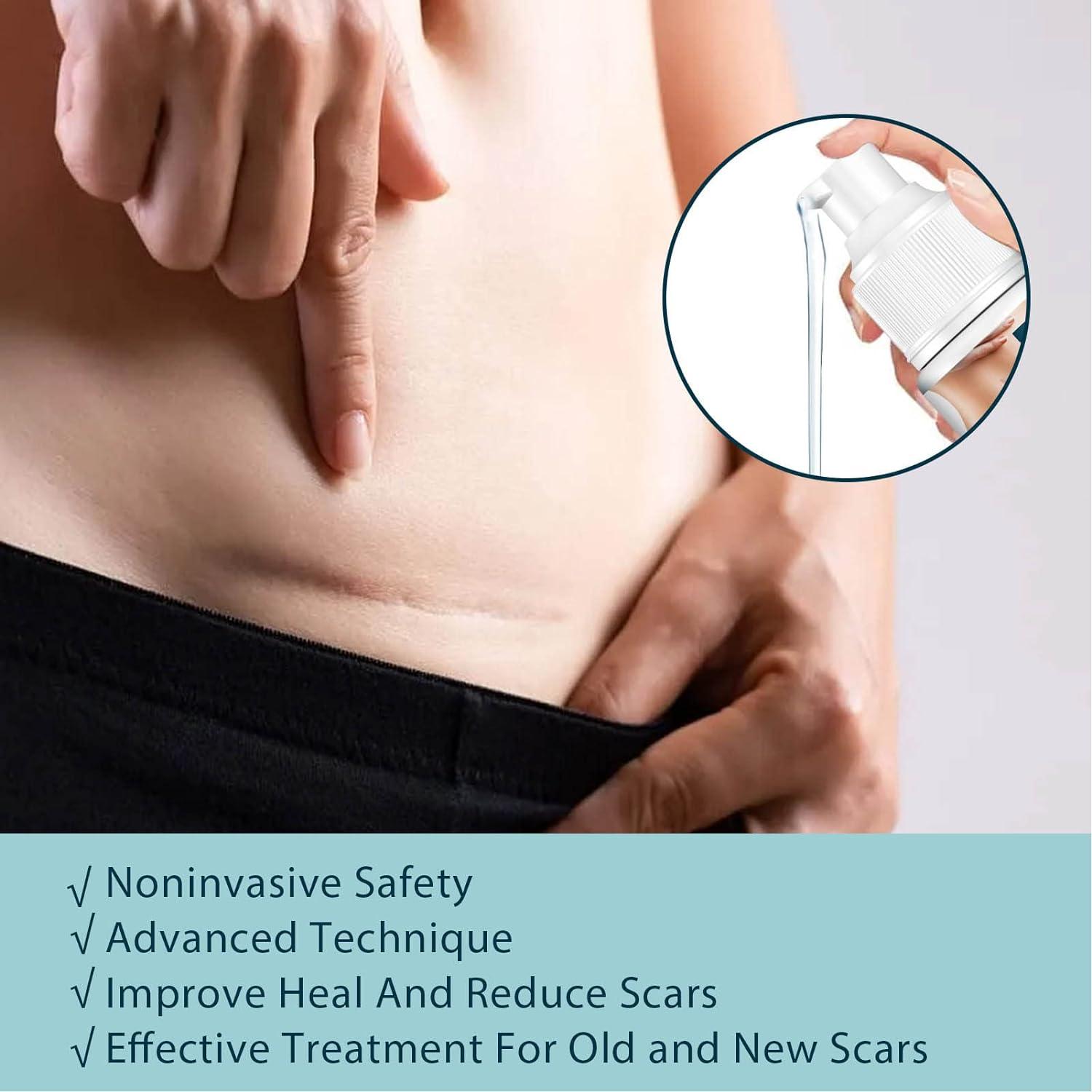 Scar Gel Cream for Surgery Injuries, Burns, Acne, & Cesarean Section ...
